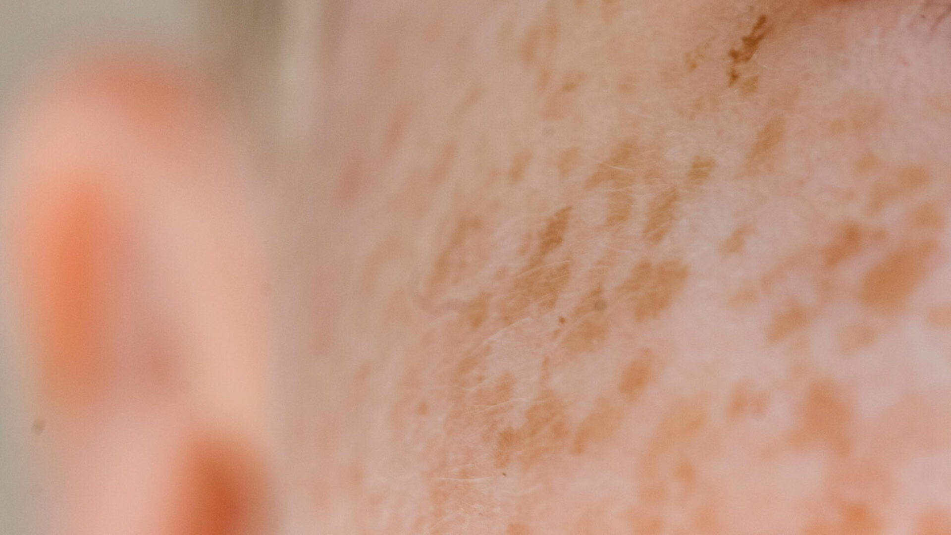 Pigmentflecken im Gesicht: Ursachen & Behandlung [+Tipps]