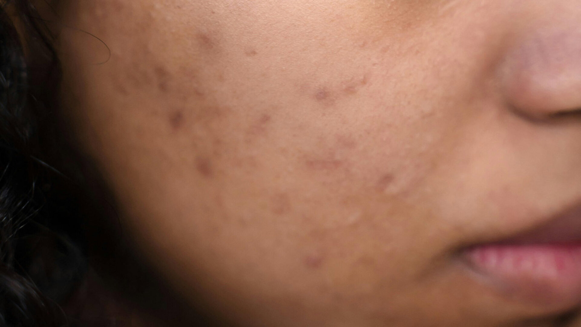 Pigmentflecken im Gesicht: Ursachen & Behandlung [+Tipps]