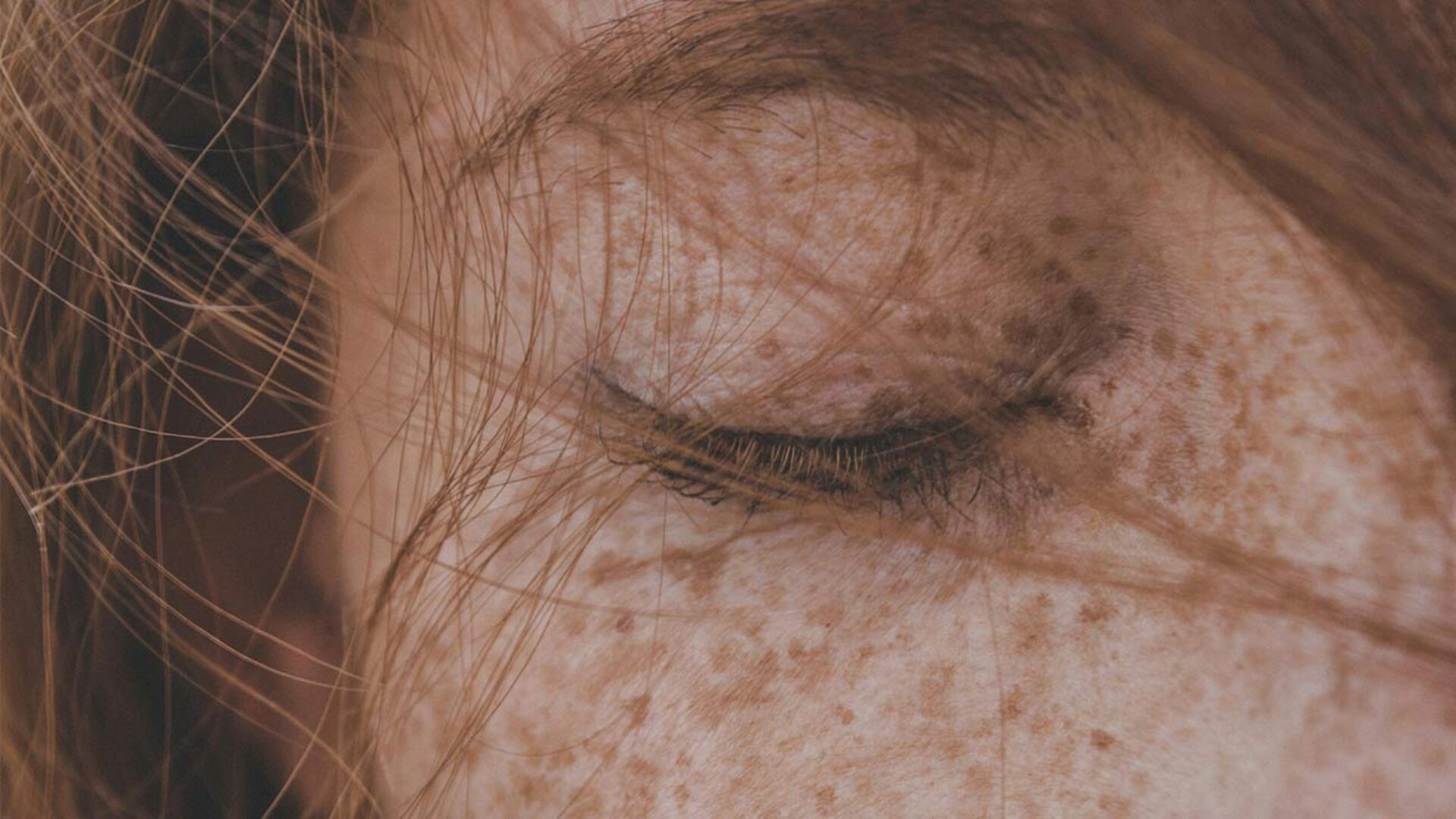 Pigmentflecken im Gesicht: Ursachen & Behandlung [+Tipps]